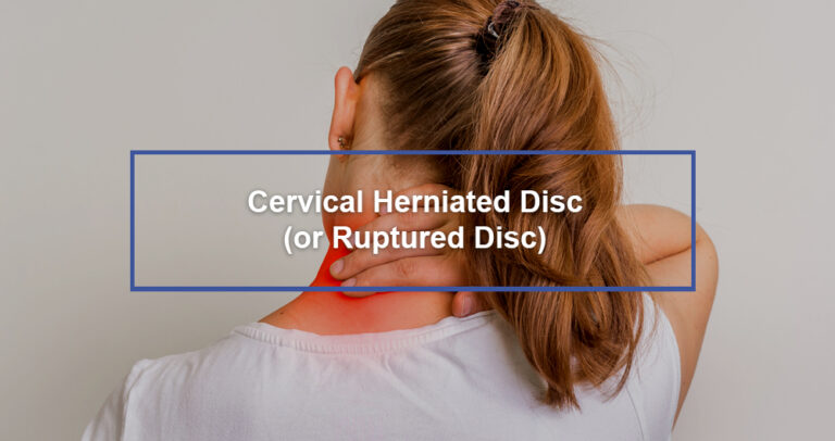 Cervical Herniated Disc (or Ruptured Disc) - Dr. Kevin Pauza, The ...