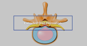 Extruded Disc Herniation - Dr. Kevin Pauza, The Discseel® Procedure ...