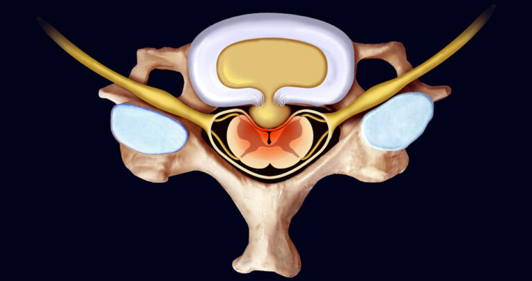 Herniated Disc In Cervical - Dr. Kevin Pauza, The Discseel® Procedure ...