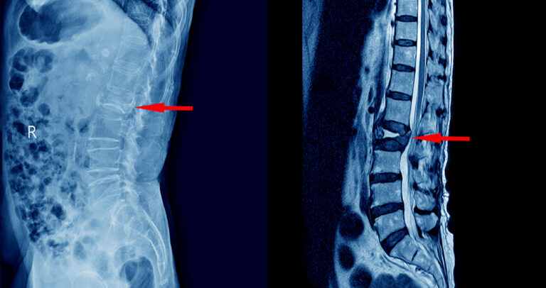 What is a Herniated Disc MRI, and When Do You Need It? - Dr. Kevin ...