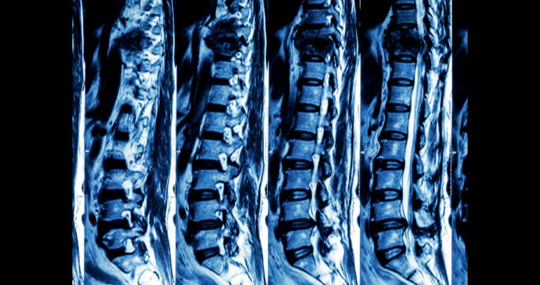 CT Scan Herniated Disc - Dr. Kevin Pauza, The Discseel® Procedure inventor
